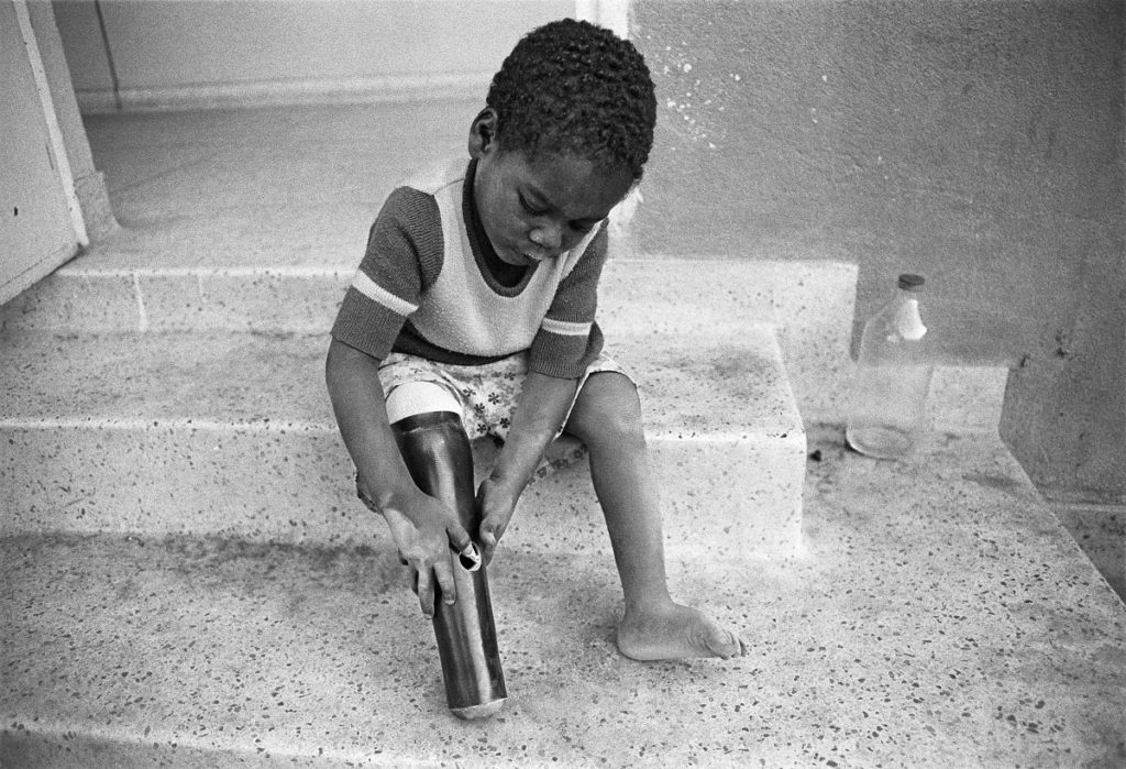 Angola. Young amputee in a physical rehabilitation centre. Blast injury ...